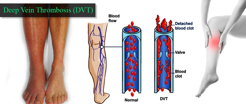 Blood Clots And Deep Vein Thrombosis: Prevention And Treatme