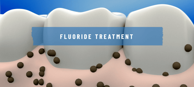 Fluoride Treatment: Benefits And Side Effects
